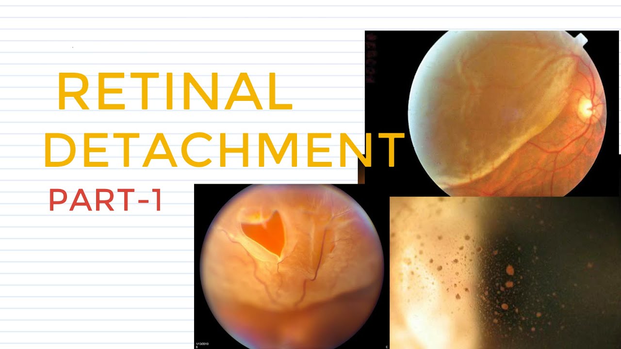 Retinal Detachment Animation Youtube