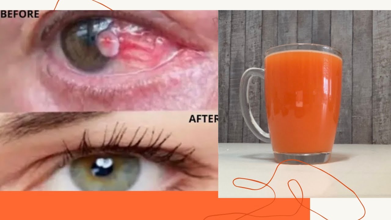 Natural homemade drink that cures Cataract| How to restore stronger ...