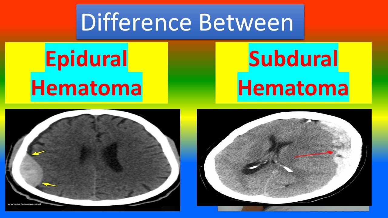 Differences Between Subdural And Epidural Hematoma Epidural Hematoma Images And Photos Finder