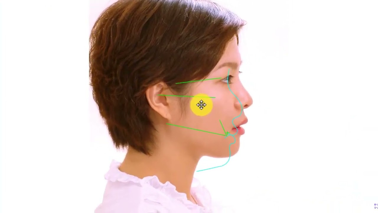 [OSSTEM CBCT] Cephalometric Analysis Software "V Ceph" - YouTube