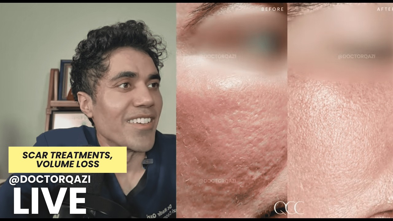 Dr. Qazi discusses Scar Treatments & More | Dr. Qazi Unsponsored Live ...