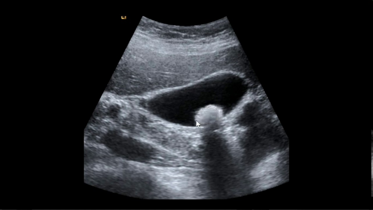 Colelitíase - YouTube