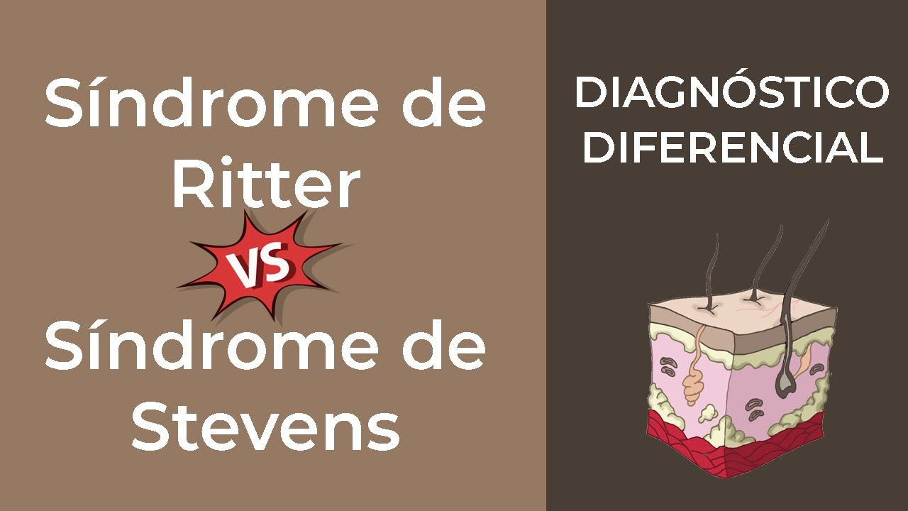 Diagnóstico diferencial. Síndrome de Ritter vs Síndrome de Stevens ...