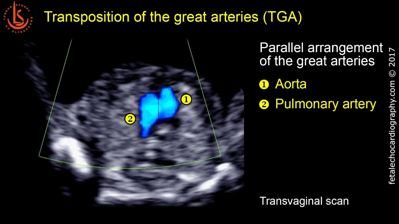 L Transposition Of The Great Arteries L Transposition Of The Great Arteries