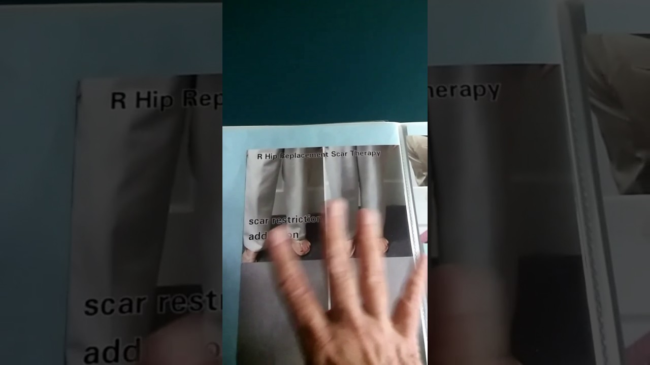 Hip Replacement Scar Caused Restriction - YouTube