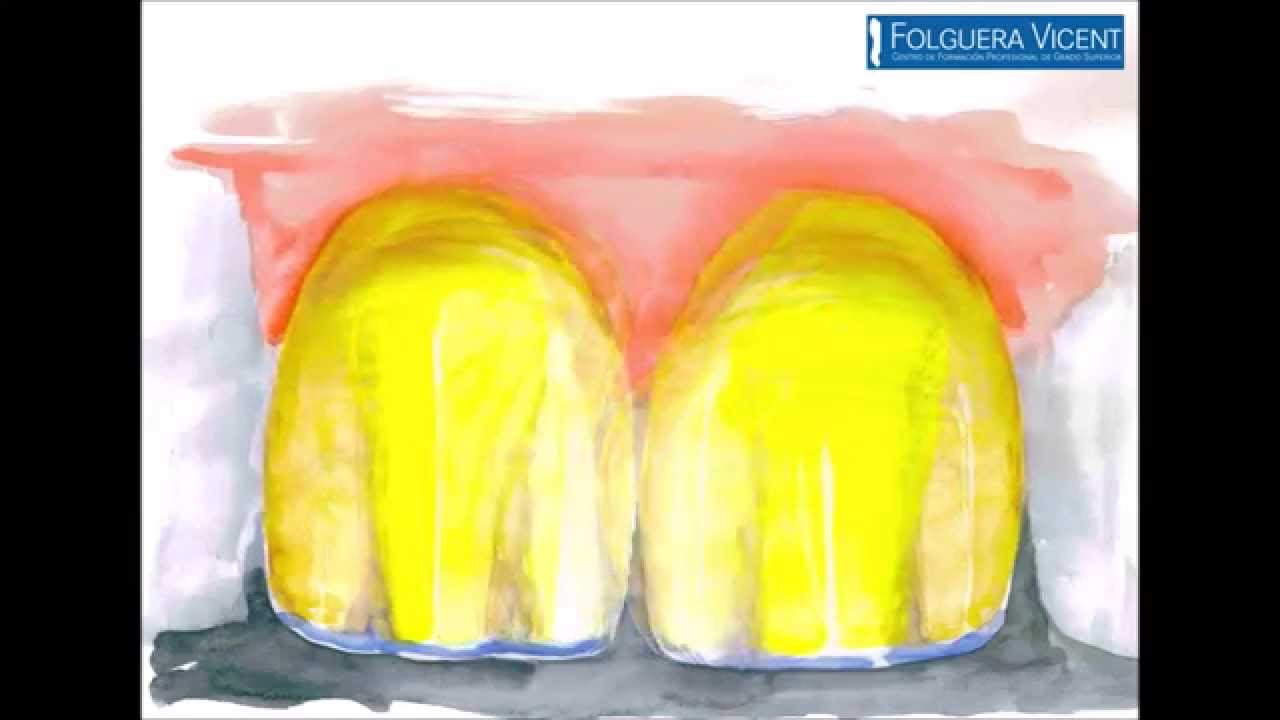 Evolución dientes incisivos centrales superiores - YouTube