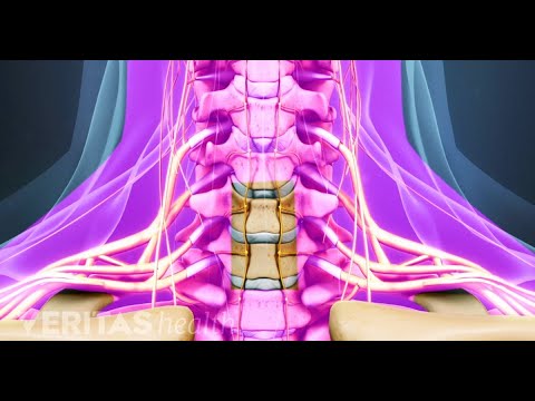 1 Day Before ACDF C5-C7 Surgery - YouTube