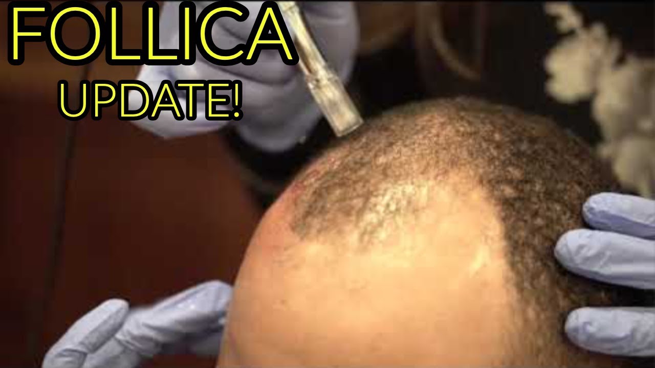 MAJOR FOLLICA HAIR LOSS TREATMENT UPDATE! - YouTube