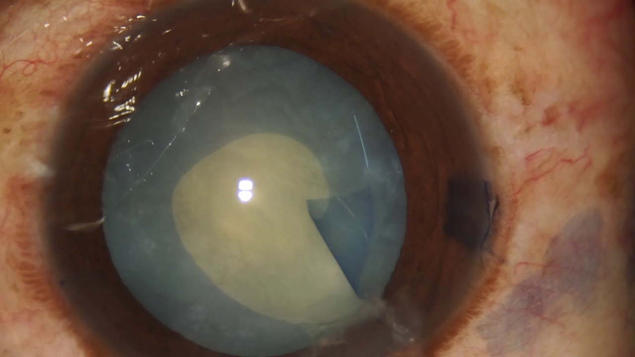 This is how I Managed Rhexis Runaway- Dr Ramakrishna Tadanki - YouTube