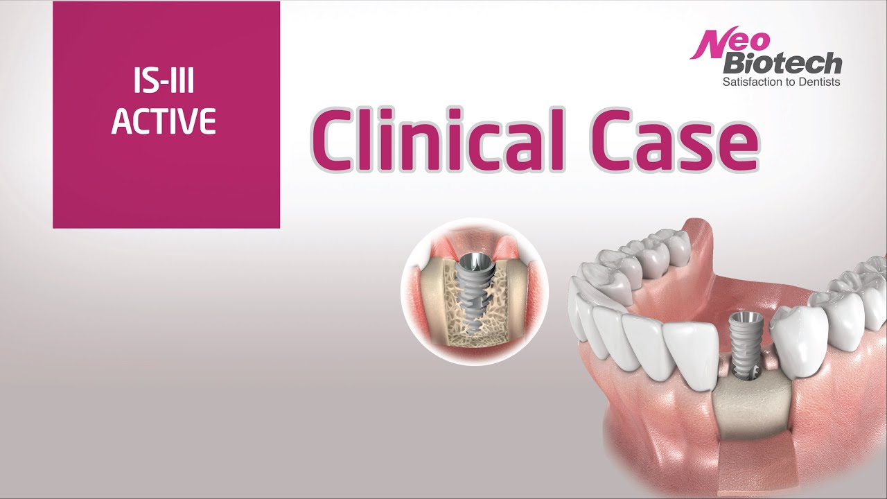 IS III active step by step procedure implant placement - YouTube
