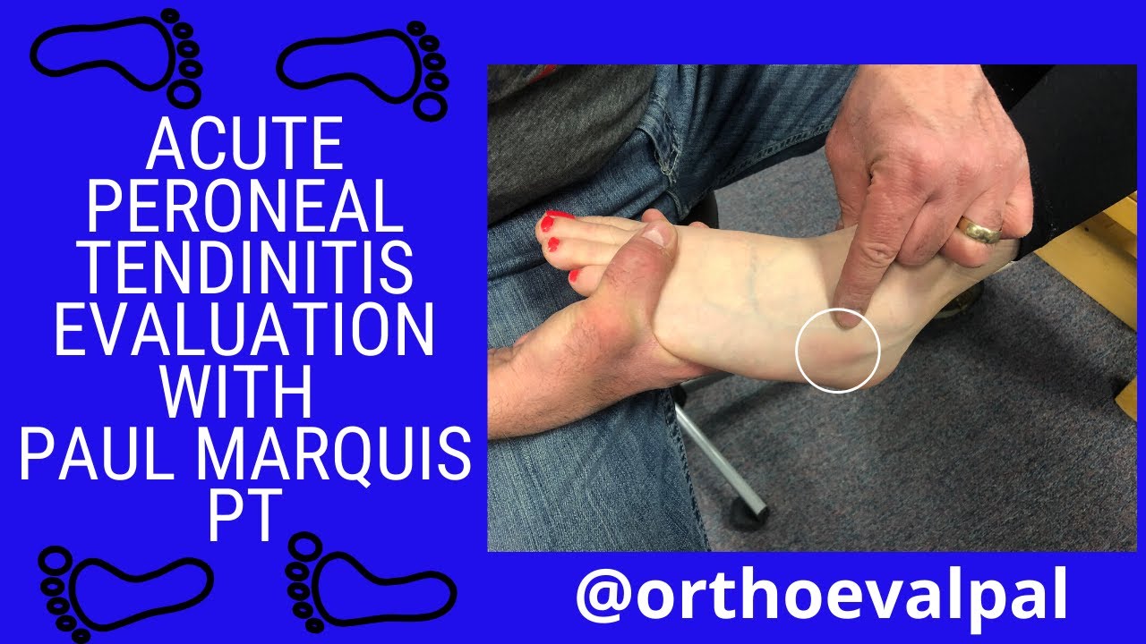 Acute Peroneal Tendinitis Evaluation with @OrthoEvalPal - YouTube