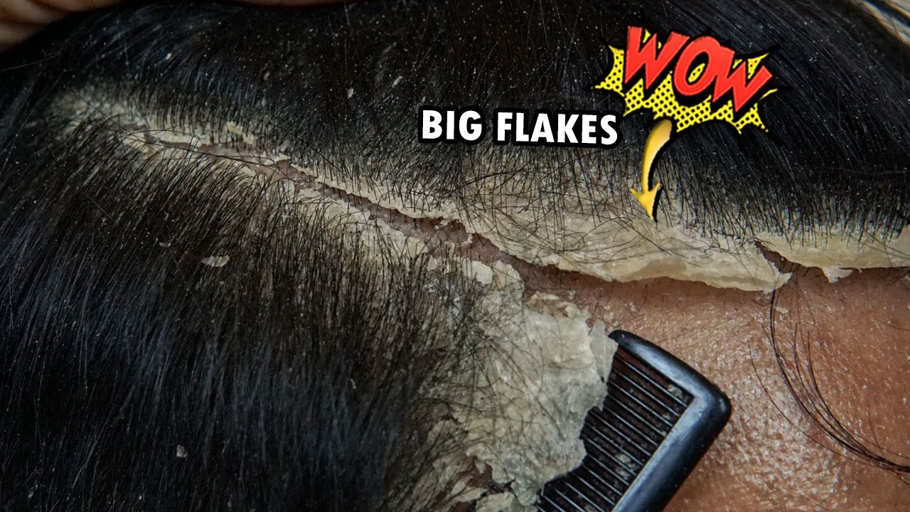 Itchy Dry Scalp Big Dandruff Flakes Scratching And Picking #815 - YouTube