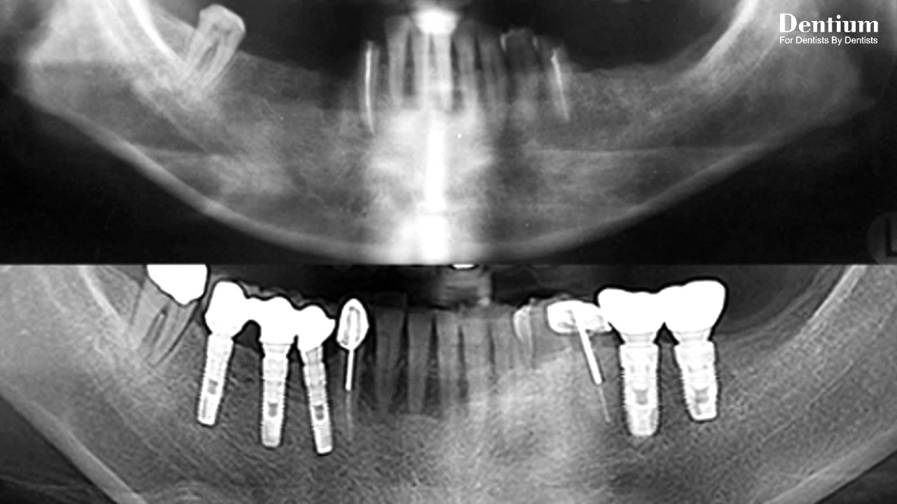 Implantium 10 years case - YouTube