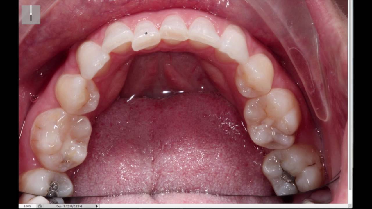 Upper and Lower Braces, 5 Visits with Bonding - Case Walkthrough - YouTube