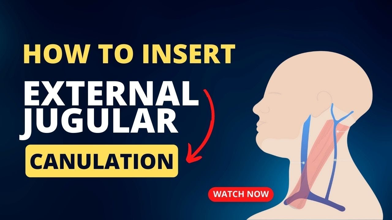External Jugular Vein Cannulation to a 2 year old child. - YouTube