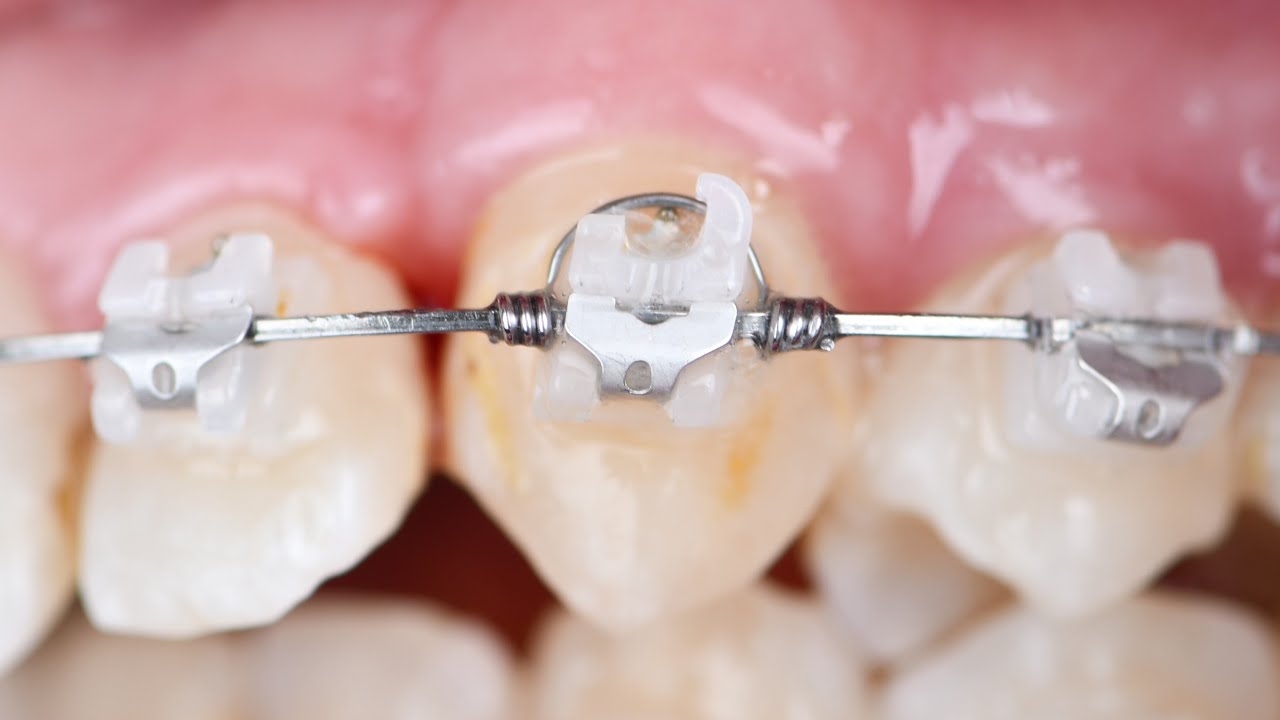 Applying torque spring, placing on torque spring with self ligating ...