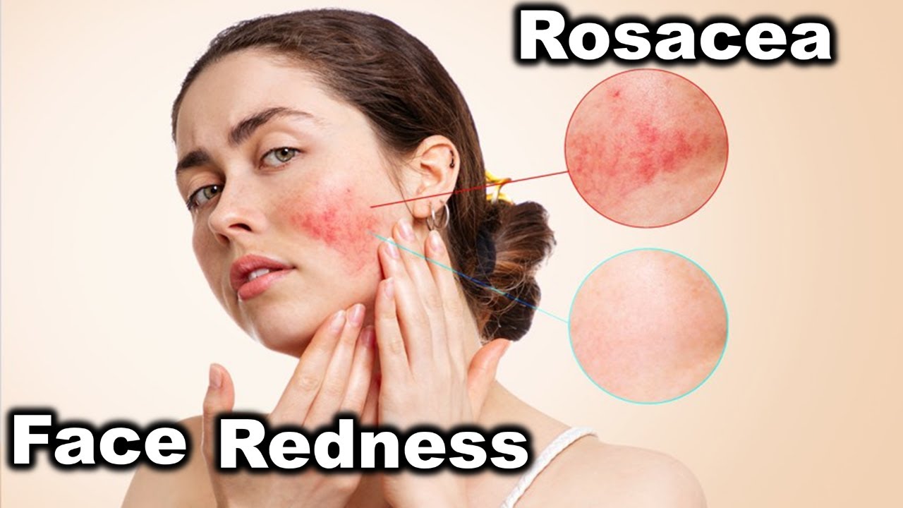how to Treat Rosacea at home || Remedies for Rosacea ||My Personal ...