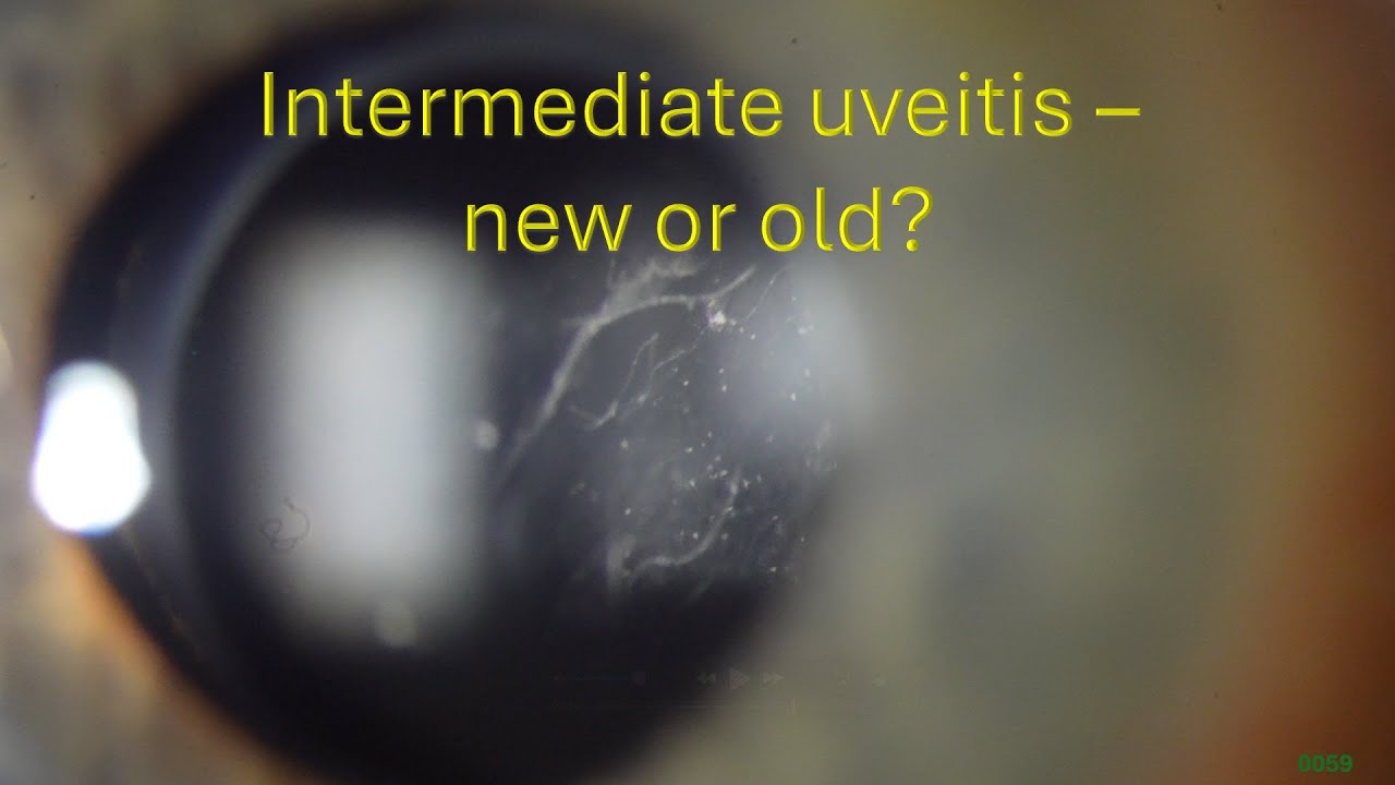 0059: Intermediate uveitis - new or old? - YouTube