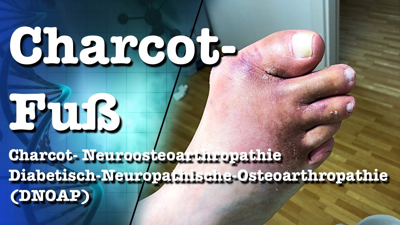 Charcot Fuß, Charcot Neuroosteoarthropathie, podologinandrea - YouTube