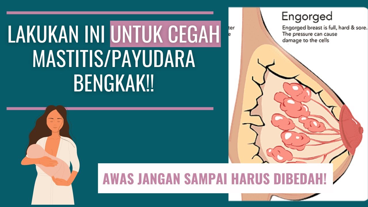 TIPS MENCEGAH PAYUDARA BENGKAK/MASTITIS - YouTube