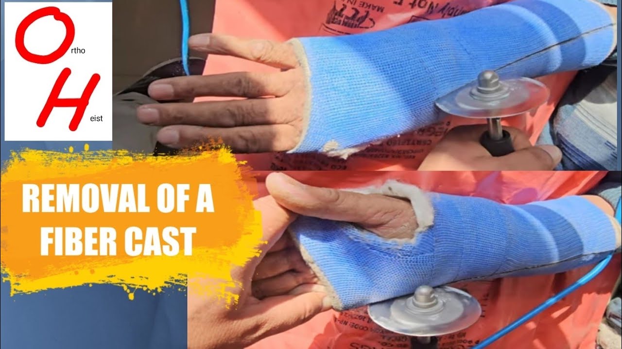 Removal of a Below Elbow Fiber Cast - YouTube