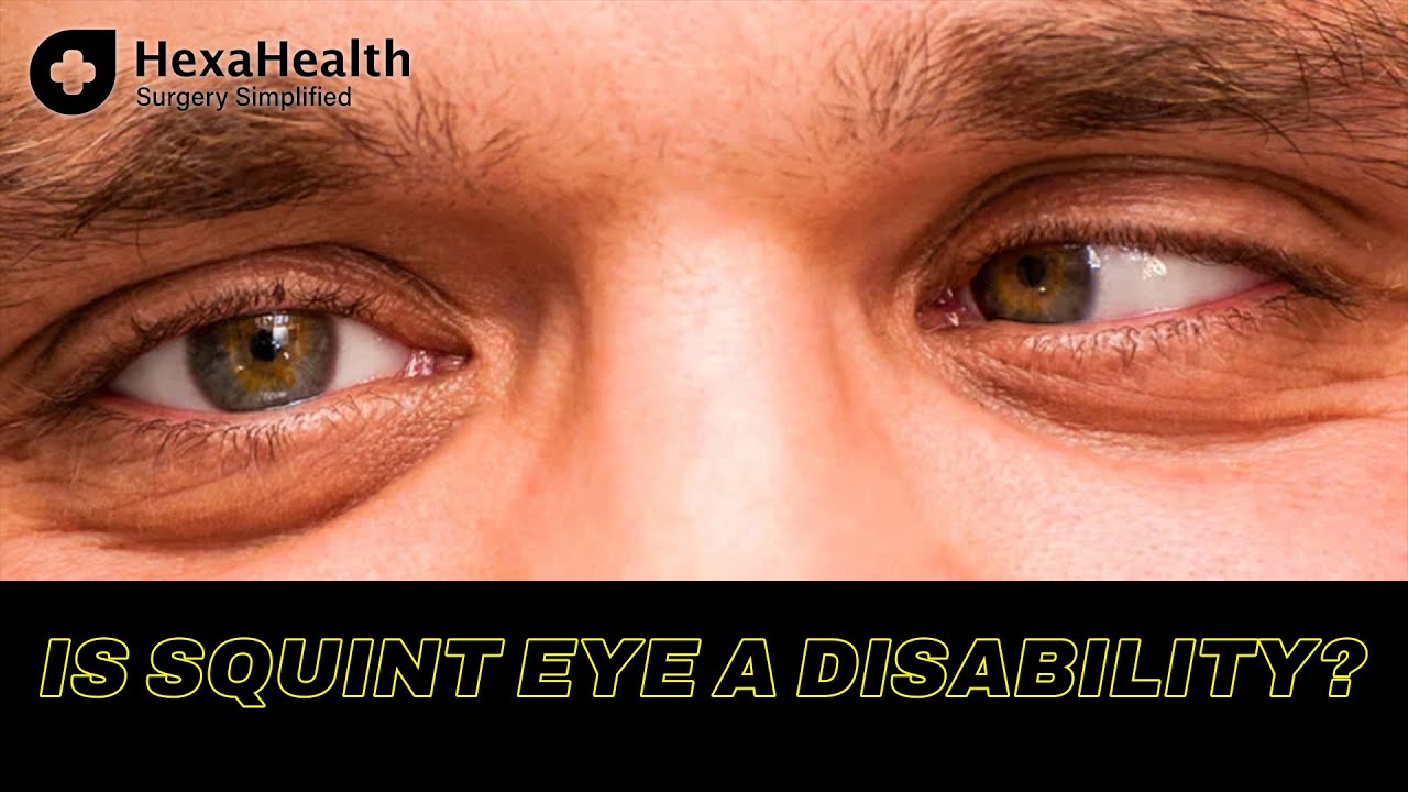 How is Squint Eye different from a Lazy Eye? || HexaHealth Expert- Dr ...