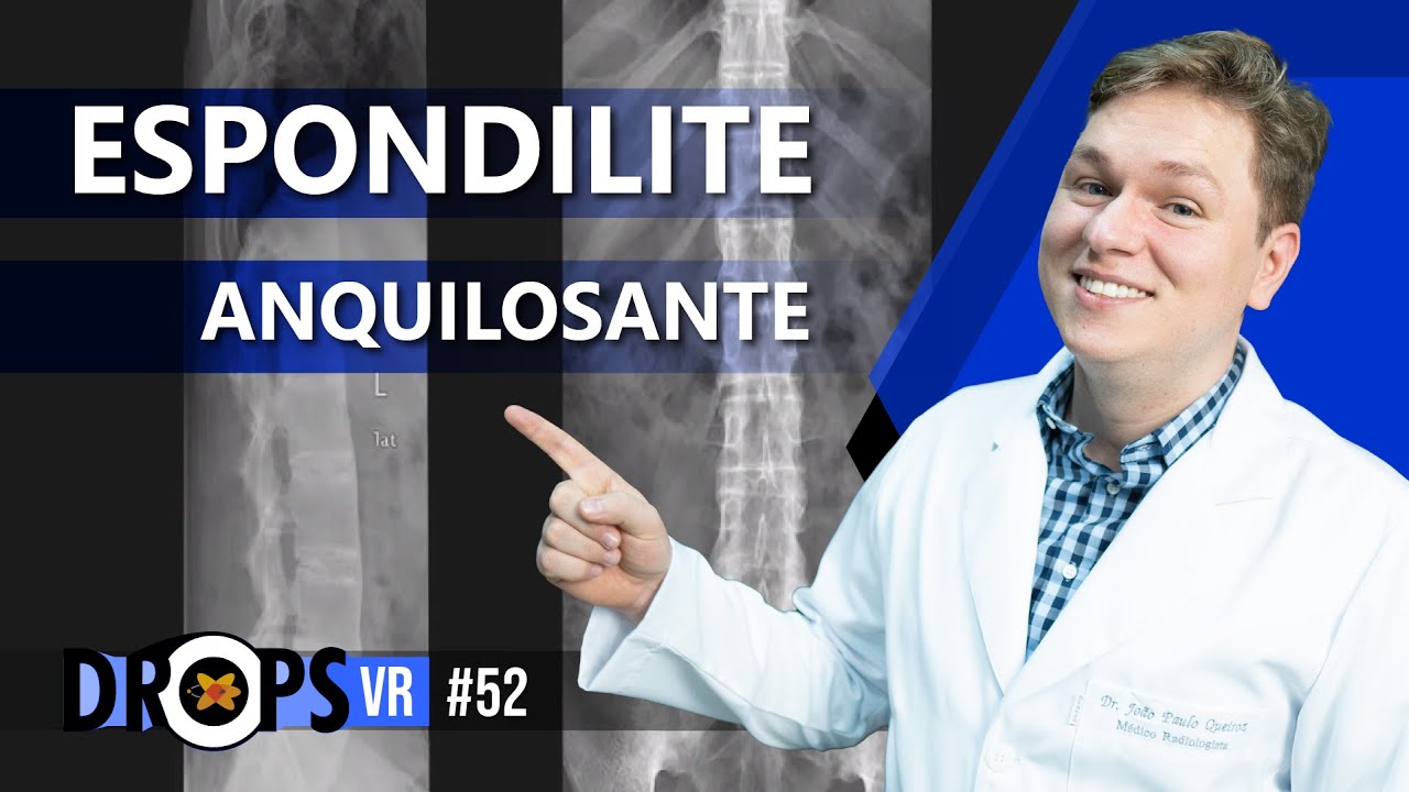 SINAIS DA ESPONDILITE ANQUILOSANTE NO RX DA COLUNA - YouTube