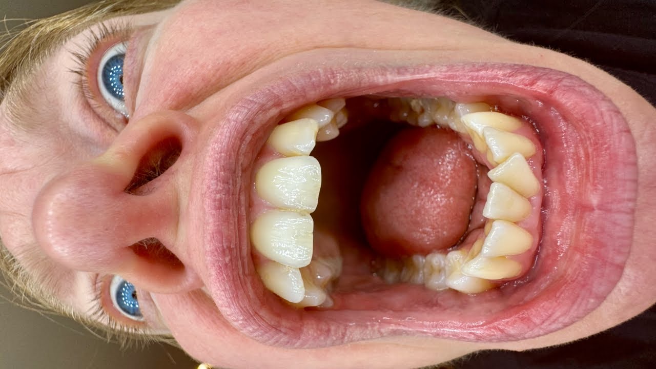 Are My Teeth Destroyed Forever?! - YouTube