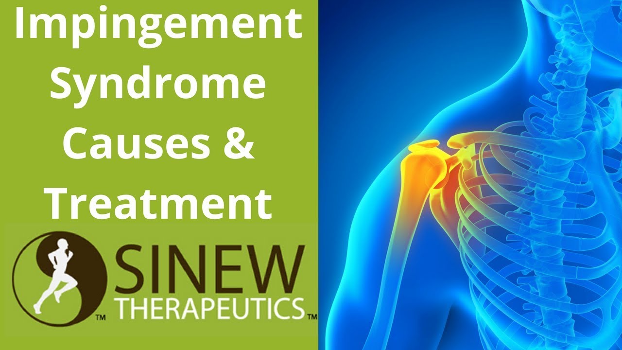 Impingement Syndrome Causes and Treatment - YouTube