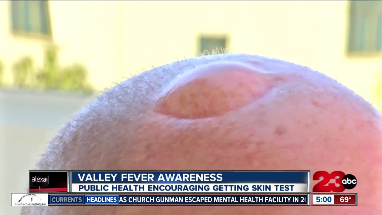 Sheriff Youngblood shares personal valley fever experience - YouTube