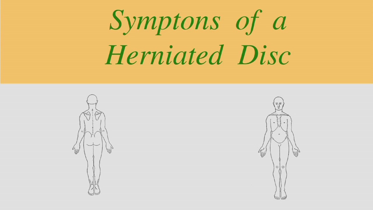 Herniated Disc Clinical Pattern - YouTube