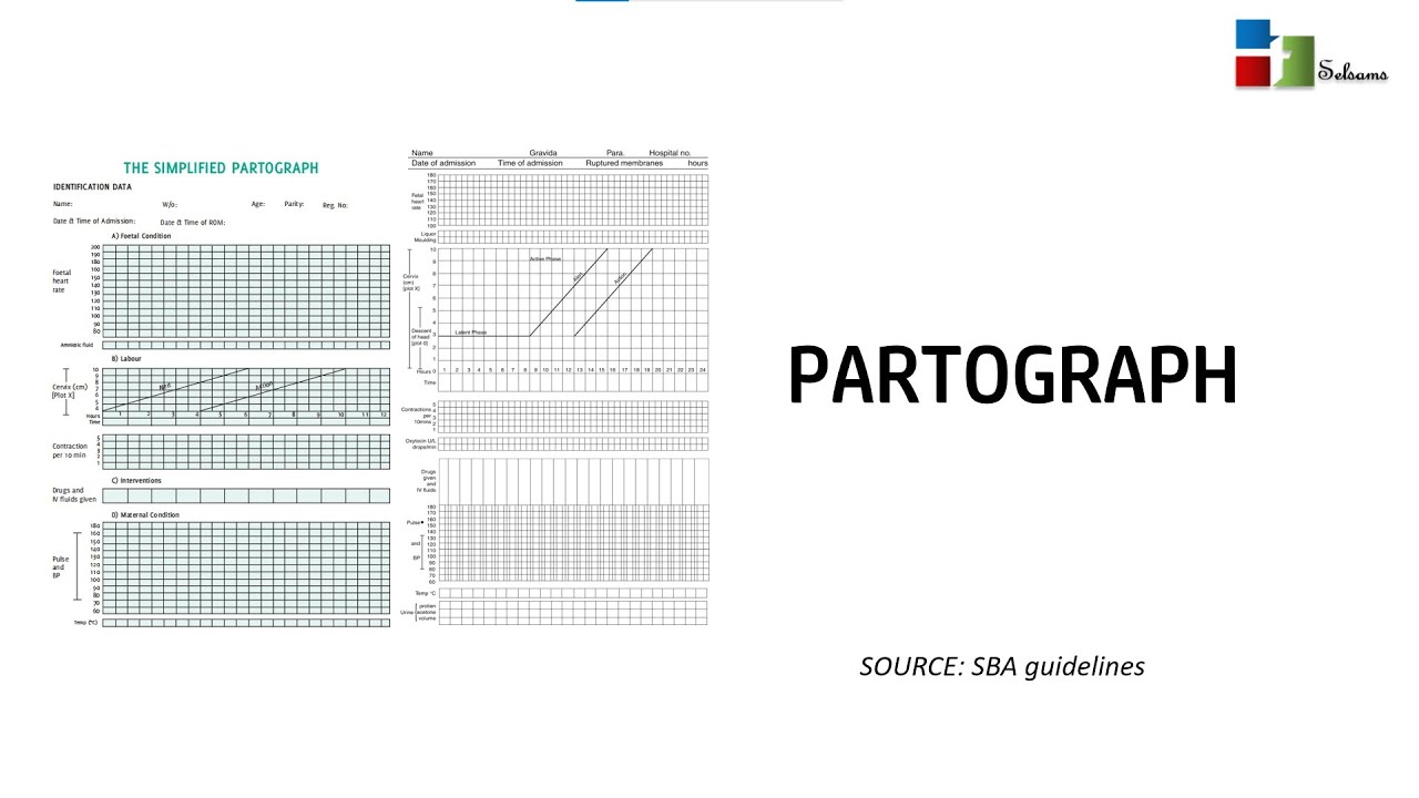 NORMAL LABOUR; I STAGE LABOUR PARTOGRAPH - YouTube