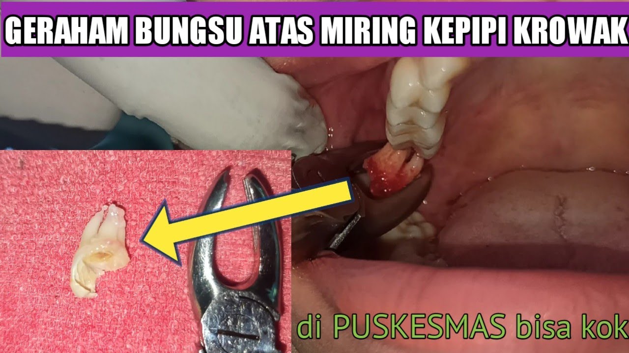 pencabutan geraham bungsu atas miring kepipi dan krowak separo di ...