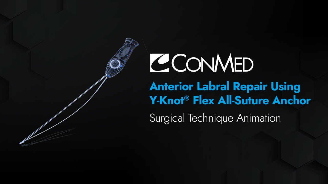 Anterior Labral Repair Using the Y-Knot® Flex - CONMED Animation - YouTube