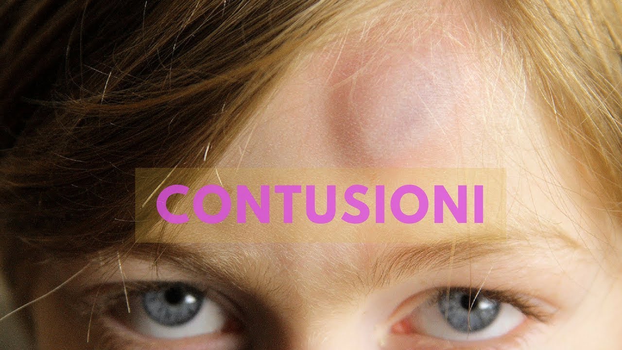 Contusioni | Pronto Soccorso Naturale - YouTube