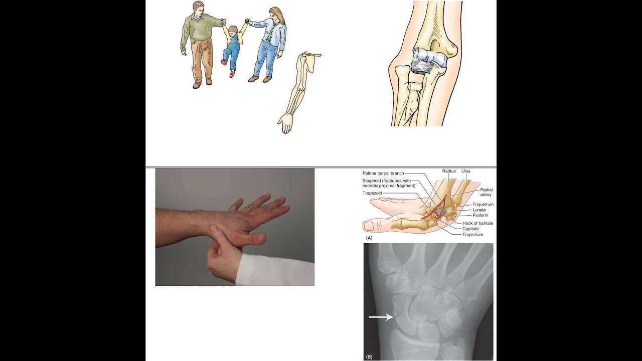 UPPER LIMB APPLIED one fractures and joints dislocations - YouTube