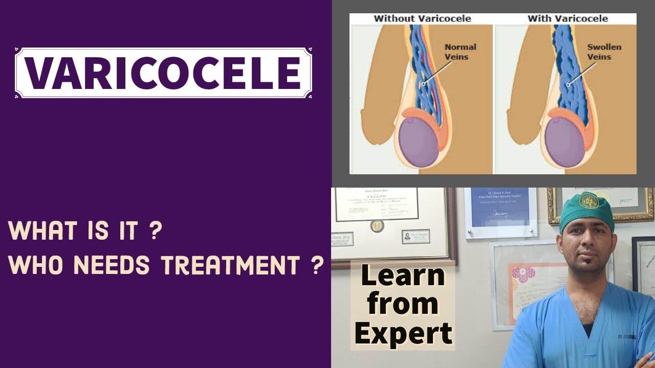 Varicocele What Is It Youtube