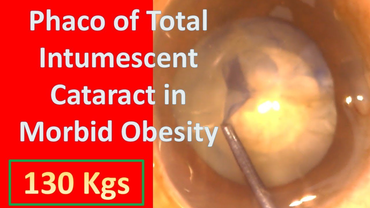 Phacoemulsification of Total Intumescent Cataract with Morbid Obesity ...