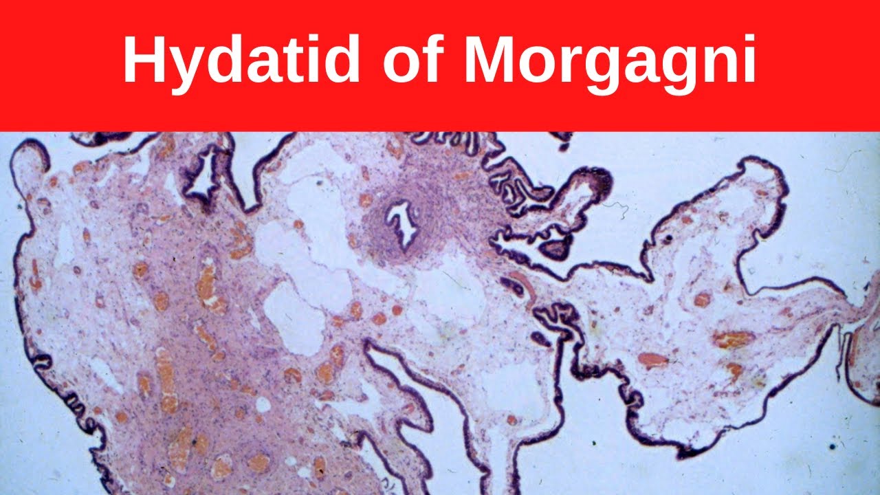 Hydatid Of Morgagni Pathology Mini Tutorial Youtube