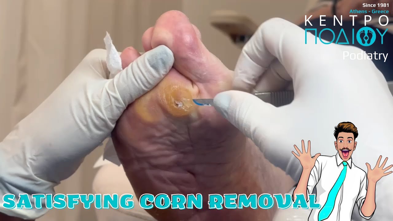 Calluses removal|Αφαίρεση κάλων|Κέντρο Ποδιού Podiatry|Podiatrist ...