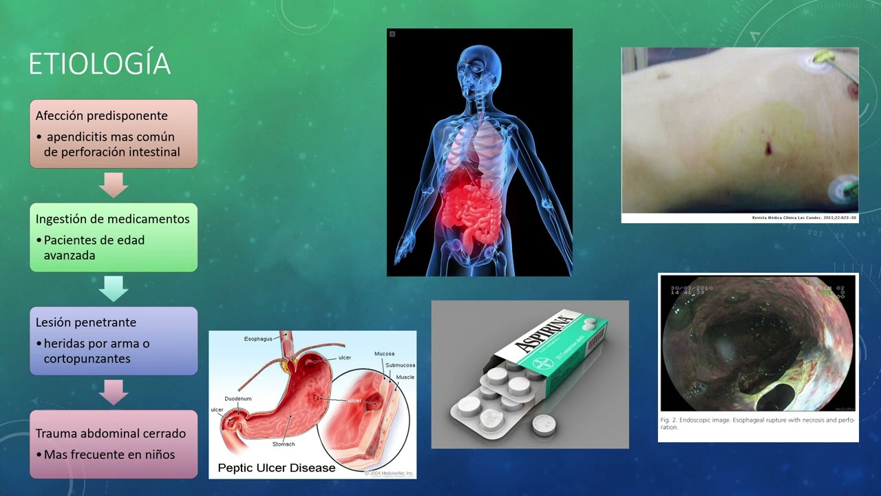 Perforación de víscera hueca- perforación intestinal - YouTube