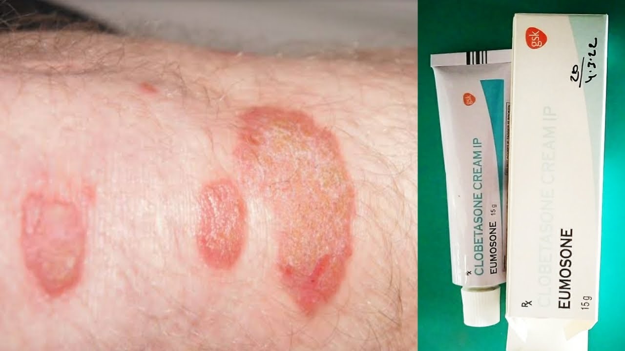 Eumosone Cream | Clobetasone Cream | Eumosone Cream Uses eczema ...