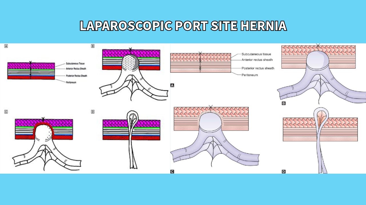 LAPAROSCOPIC REPAIR OF PORT SITE HERNIA | PORT SITE HERNIA REPAIR ...