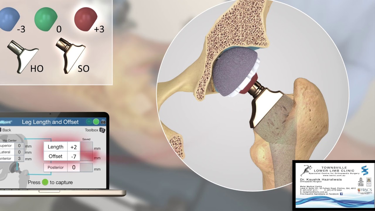 Intellijoint - YouTube