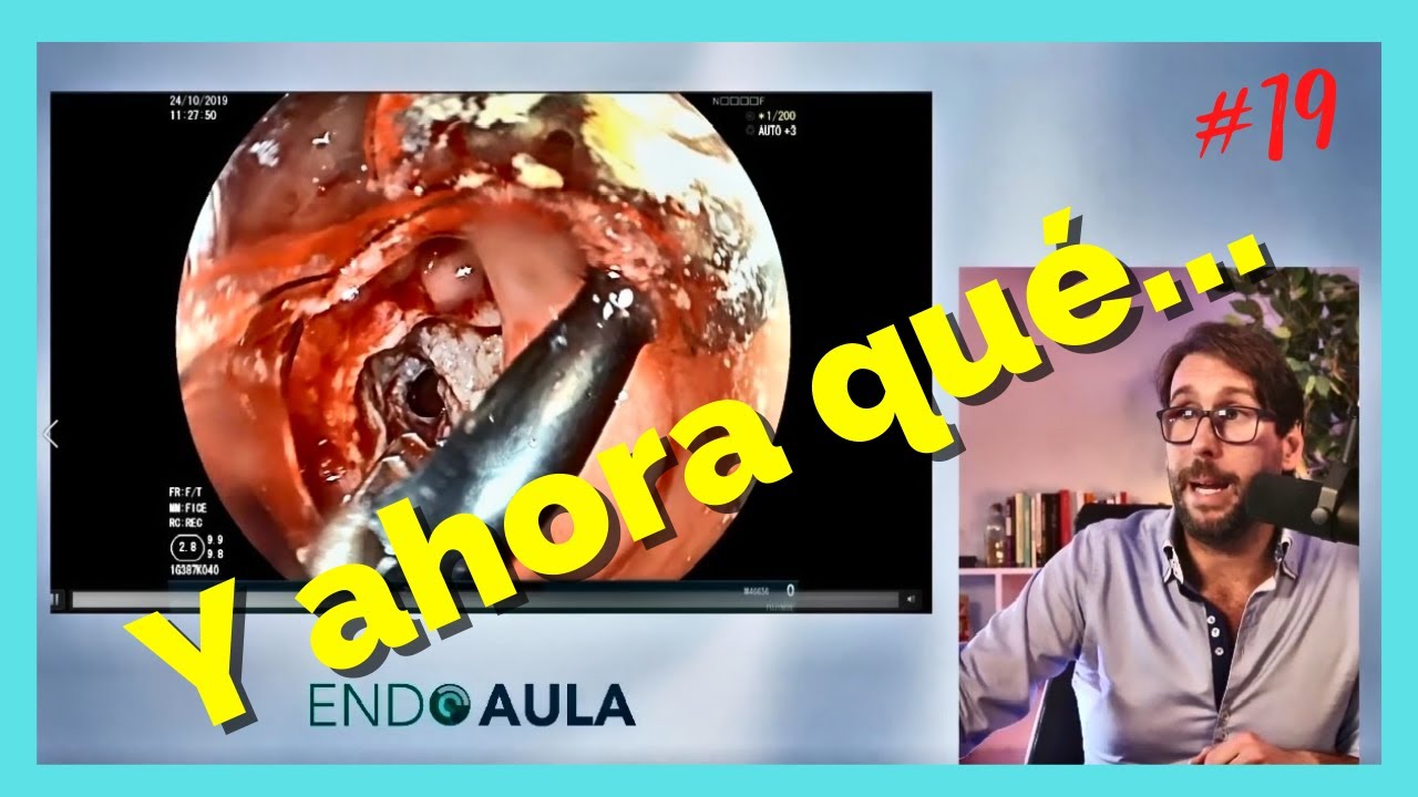 😱PERFORACIONES de colon😱 y cómo RESOLVERLAS. CURSO ENDOSCOPIA ...