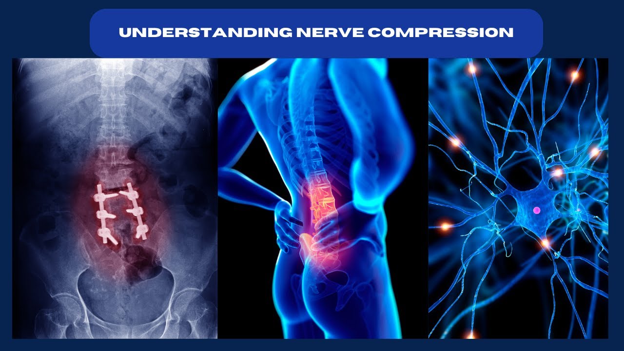 Understanding Nerve Compression II Nerve Pain Treatment 2024 | Nerve ...