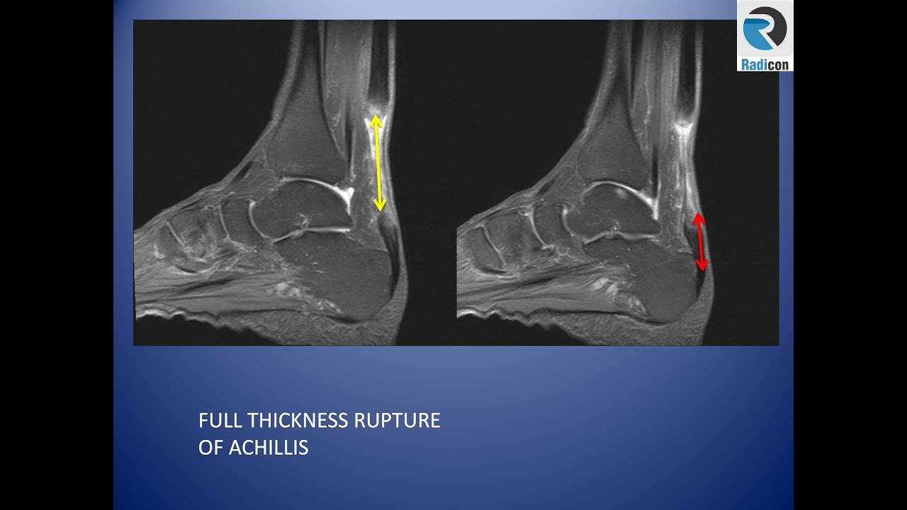 Ankle MRI Part 4: Achilles and Plantar Fascia - YouTube