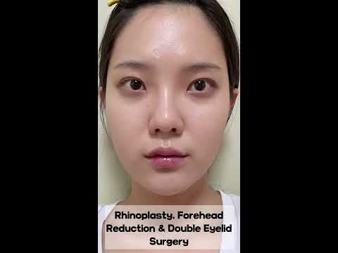 [Plastic Surgery in Korea] Rhinoplasty, Forehead Reduction & Double ...