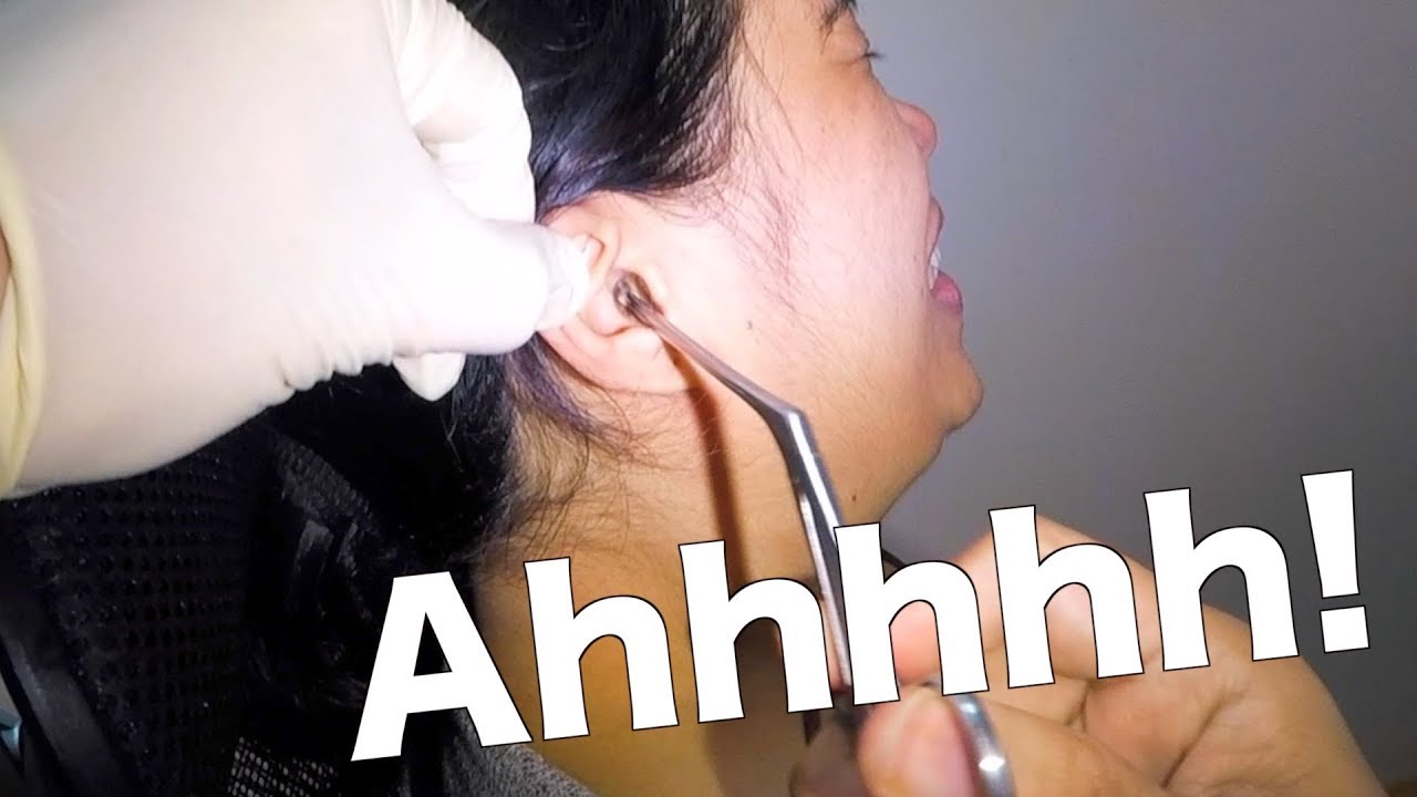 Something Plastiky Stuck In Woman's Ear Finally Removed- What Is It ...