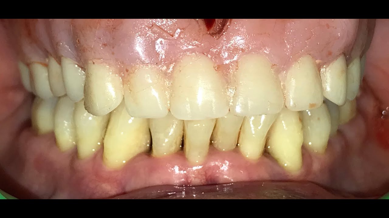 Extracciones multiples y Protesis Inmediata - YouTube